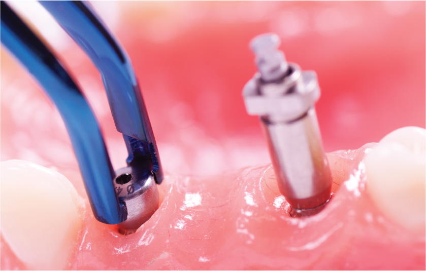 Luxator rootpicker - Kẹp gắp mảnh vỡ sau nhổ răng - Dentech Việt Nam